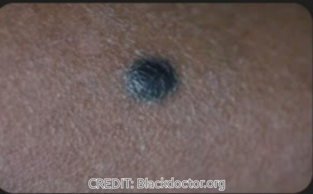 How To Remove Moles From Face Naturally » SkinOl Cosmetics