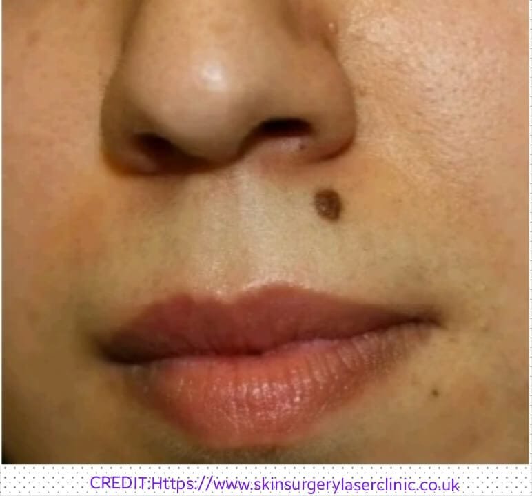 Mole Removal Before And After » SkinOl Cosmetics